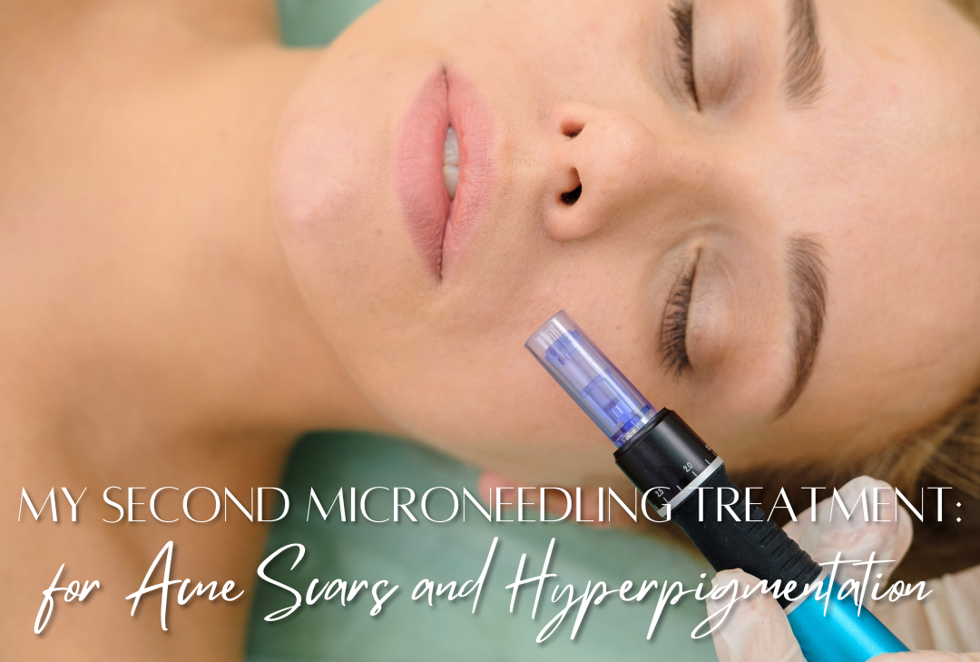 My Second Microneedling Treatment for Acne Scars and Hyperpigmentation ...